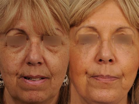 Photos De Rajeunissement Facial Avant Et Apr S
