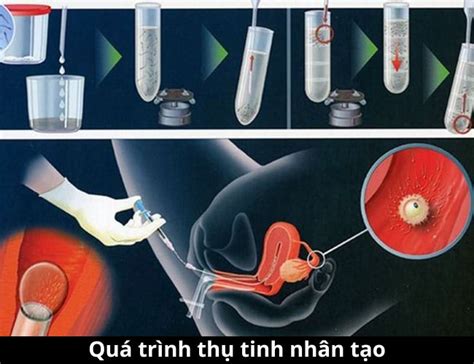 Thụ tinh nhân tạo là gì Thụ tinh nhân tạo cần chuẩn bị gì giá bao nhiêu