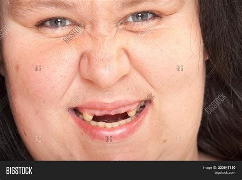 Picture Of Woman With Missing Teeth TeethWalls