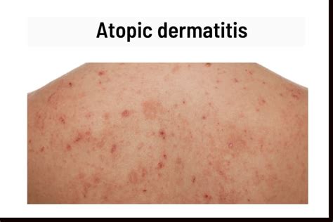 Red Spots On Skin 38 Causes Pictures And Treatment