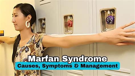 Marfan Syndrome Causes Symptoms And Management