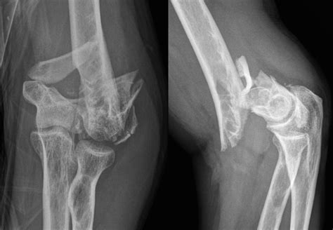 Fracture du coude Clinique Ostéo Articulaire des Cèdres Grenoble
