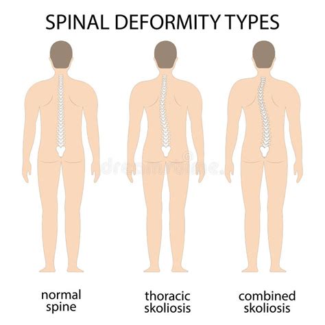 Kyphosis Lordosis And Scoliosis Spine Infographic Body Posture