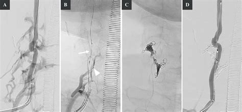 A Preoperative Right Vertebral Angiography Anteroposterior View