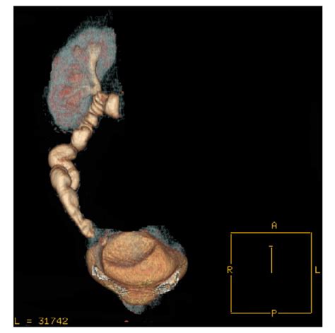 Three Dimensional Reconstructed CT Scan Performed After Surgery