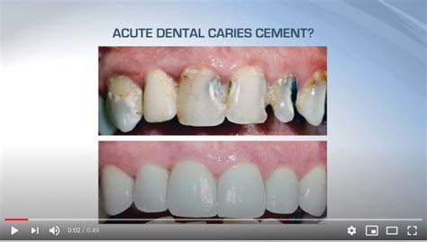 The NEW Glass Ionomers Really Work V3514 Operative Dentistry CE