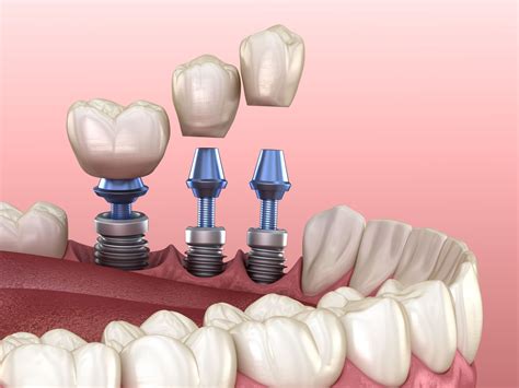 Implantología Dental Ruiz Mazo