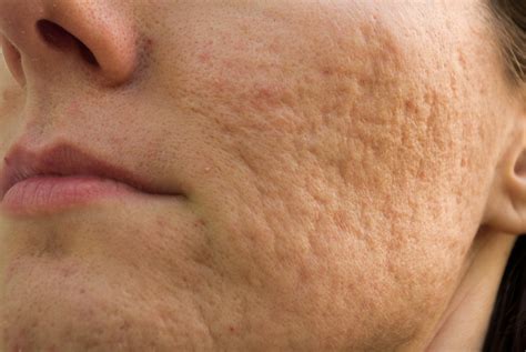 How To Fill Pitted Acne Scars With Makeup Saubhaya Makeup