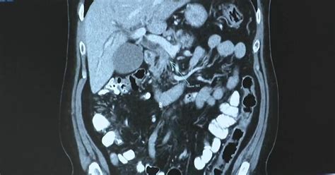Early Detection Can Make All The Difference With Pancreatic Cancer