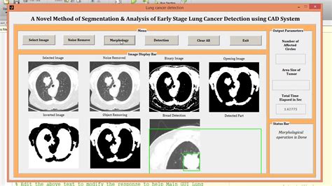lung cancer detection using cad matlab project source code youtube