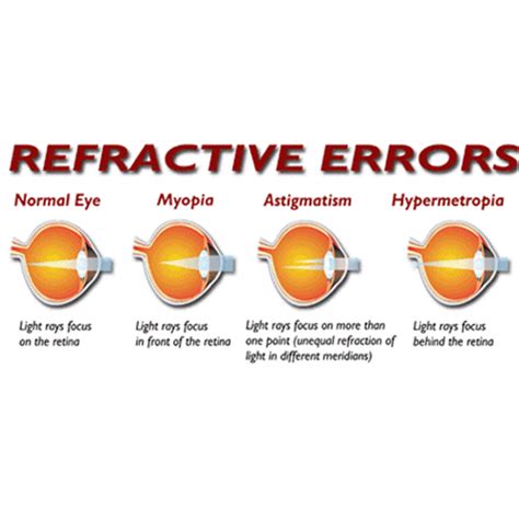 Refractive Errors Contact Lens Dr Monicas Eye Clinic