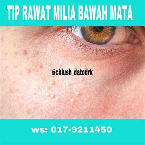 Cara Nak Menghilangkan Milia Di Muka DelilahrosCastillo