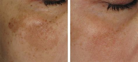 Pigmentation Before After Kingsway Dermatology