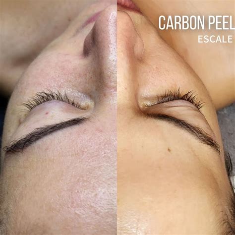 All About The Carbon Peel Process Effects And Costs