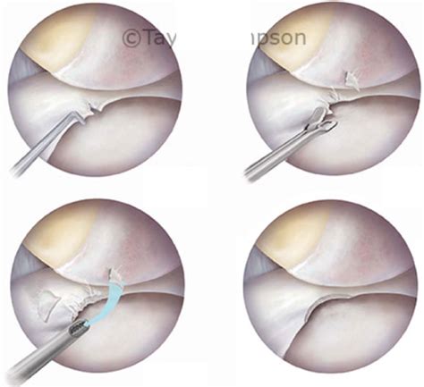Meniscus Tear Repair Treatment Surgery In Melbourne