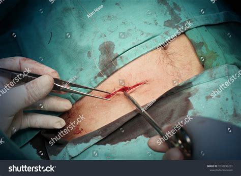 Simple Interrupted Close Suturing Technique Apply Stock Photo