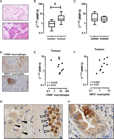 Matrix Metalloproteinase 9 MMP 9 Transcript Is Increased In The