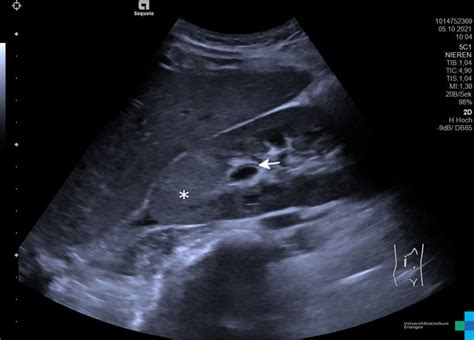 Pyelonephritis Sonographieatlas Erlangen