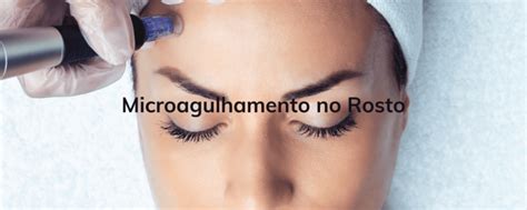Microagulhamento no Rosto Clinica Humanitá