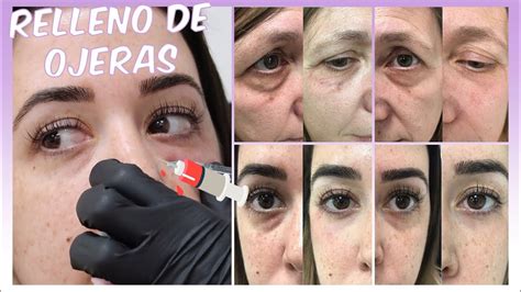 DESPIDETE DE TUS OJERAS RELLENO CON AC HIALURÓNICO YouTube