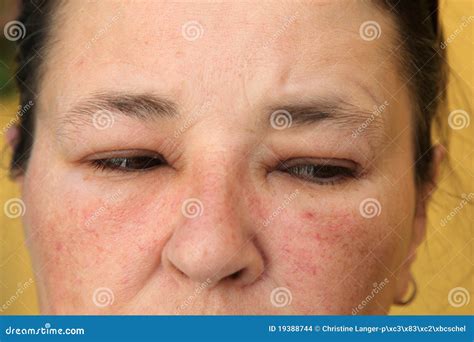 Tät Bindhinneinflammation För Allergi Upp Arkivfoto Bild av vuxen