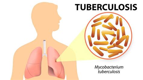 Tuberculosis la enfermedad que puede causar daño permanente en los