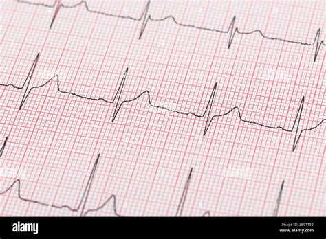 Electrocardiogram Ekg Hi Res Stock Photography And Images Alamy