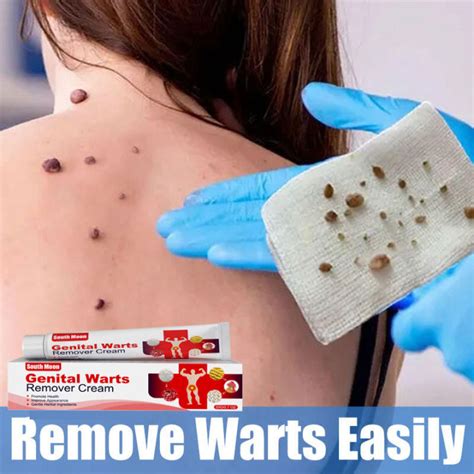 Warts Remover Cream Ubat Buang Kutil Ketuat Tahi Lalat Biji Kolestrol