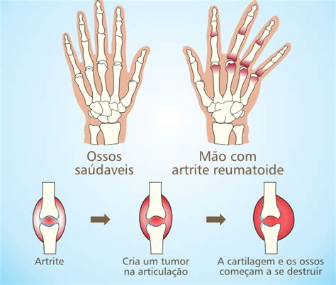 Artrite reumatoide conheça as causas sintomas e tratamentos FisioDeller