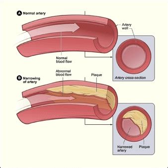 Coronary Artery Disease CAD Cardiac Surgery Michigan Medicine