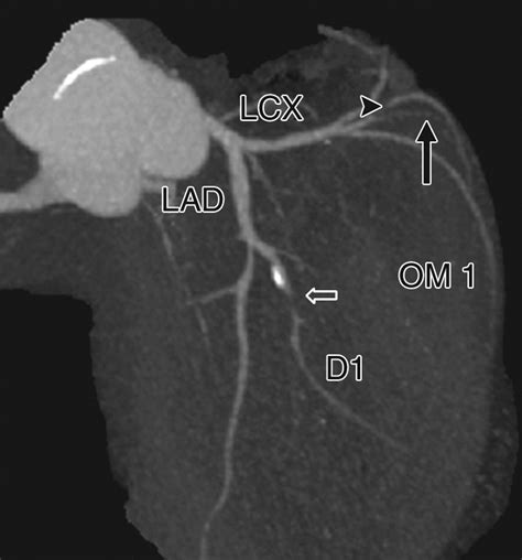 Coronary Artery Stenosis In High Risk Patients 64Section CT And