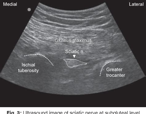 Figure 4 From Ultrasound Guided Approaches To Sciatic Nerve Block