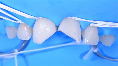 Reabilitação estética anterior do clareamento à reconstrução