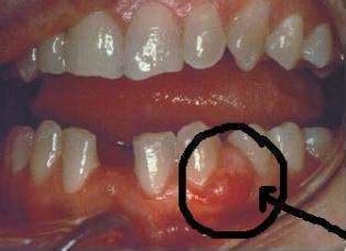 Absceso Gingival EcuRed
