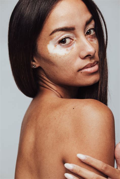 Post Summer Holistic Treatments For Hyperpigmentation LYDIA SARFATI