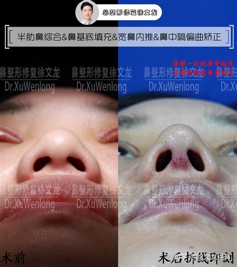肋骨鼻 知乎