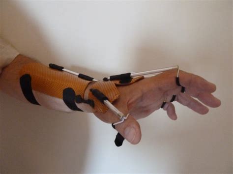 Splint In The Spotlight Radial Paralysis A Progressive Orthosis