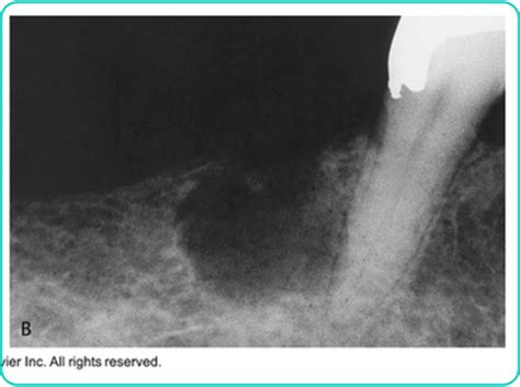 Chapter 5 Oral Pathology Pictures Flashcards Quizlet