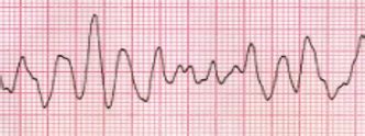 Cu Les Son Los Ritmos Electrocardiogr Ficos Que Se Pueden Identificar