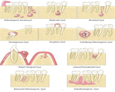 Oral Pathology Chapter Flashcards Quizlet