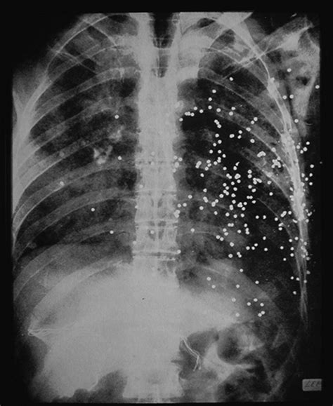 Trauma Chest X Ray