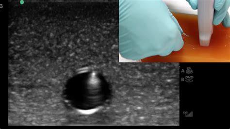 Ultrasound Guided Peripheral Intravenous USGPIV Catheterization