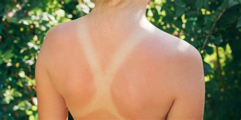 Peligros de exponerse al sol sin protección Doctoranytime Blog