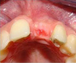 Cuidados después de una extracción dental Dentisalut