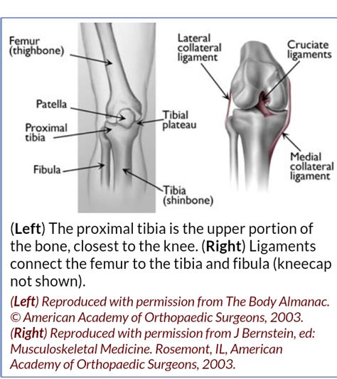 Fractures Of The Proximal Tibia Shinbone Knee Injury Tibial