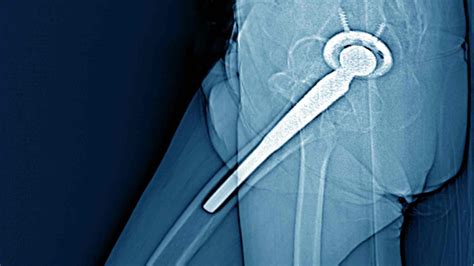 What Is An Anterior Hip Approach Orthopaedics Art
