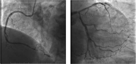 Clinical Application Of Myocardial Perfusion SPECT In Patients With