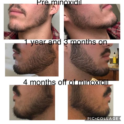 Minoxidil Before And After Beard Result How To Use Minoxidil Solution