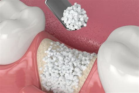 Regeneraci N Sea Qu Es Y Cu Ndo Se Necesita Sebydent Dentistas