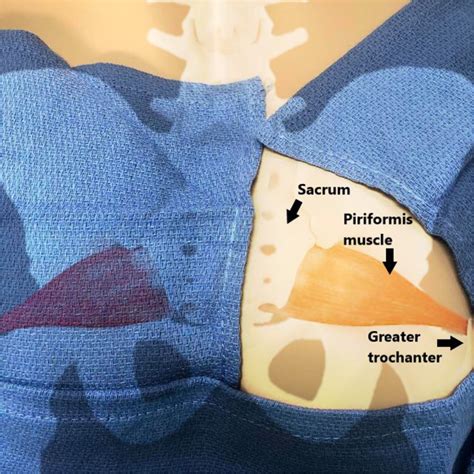 Ultrasoundguided Trigger Point Injection For Piriformis Syndrome In